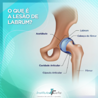 O que é lesão do labrum? – Tratamento de Joelho e Quadril em Curitiba