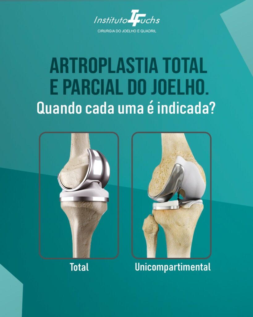 Artroplastia De Joelho Cid - RETOEDU
